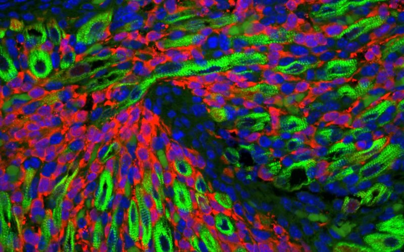 Researchers discover that a “muscle” cancer is not really a muscle ...