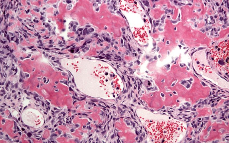 Tracking the source of bone cancer mutations - St. Jude Children’s ...